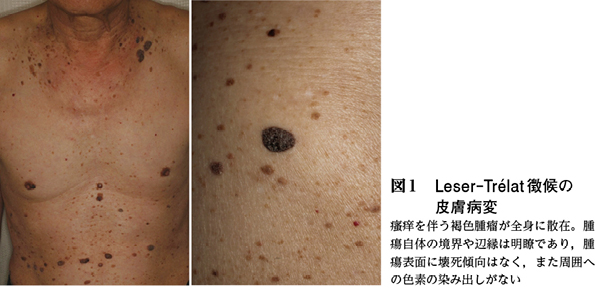 75歳，男性。主訴：瘙痒を伴う褐色腫瘤が多発（図1）